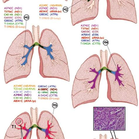 Pattern Of Mtdna Mutation In Patient 2 The Patient Was Operated On