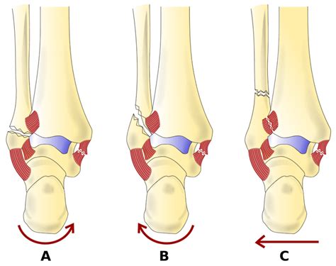 Agape Physiotherapy Understanding The Types Of Weber Ankle Fractures And Their Management