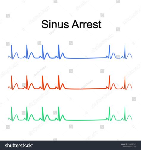 Sinus Arrest Sinus Pause On Electrocardiogram Stock Vector Royalty Free 1746907283 Shutterstock
