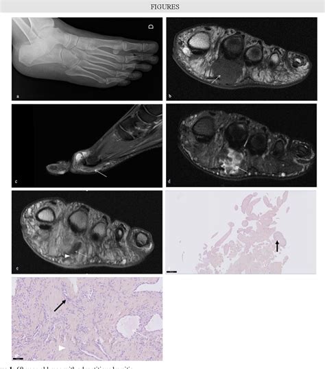 Table 1 From Adventitious Bursitis In The Plantar Fat Pad Of Forefoot Presenting As A Tumoral