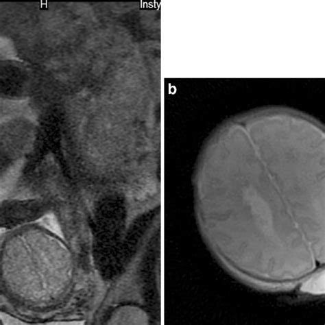 The Aitken Classification Of Pffd With Permission Of Dr Jeanty