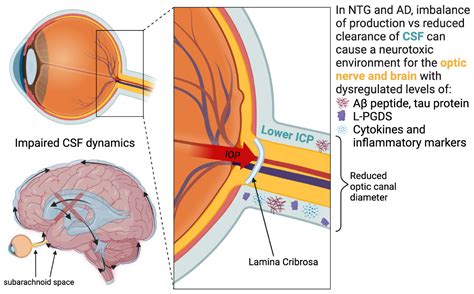 Jcm Free Full Text Normal Tension Glaucoma And Potential Clinical Links To Alzheimers Disease