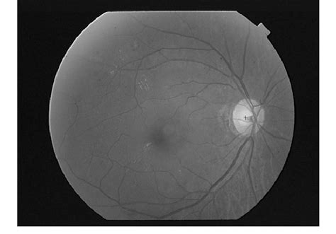 Optic Disc Detection Download Scientific Diagram