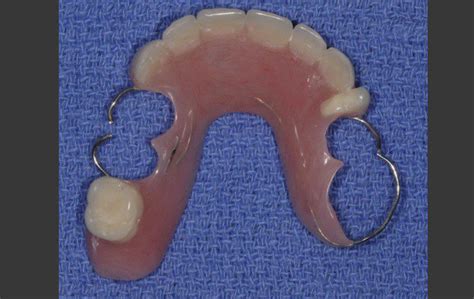 Lower Partial Dentures With Pics Dental Implant Center