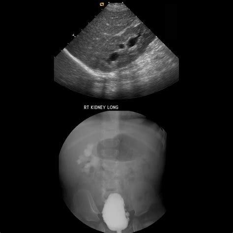 Pediatric Neurogenic Bladder Pediatric Radiology Reference Article Pediatric Imaging