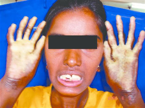 Pls Patient With Characteristic Palmar Keratoderma And Dental Download Scientific Diagram