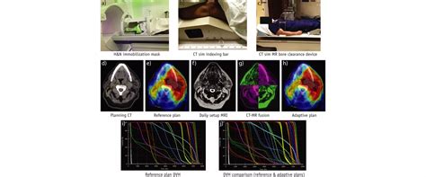 Adaptive Radiotherapy Unihealth Turkey