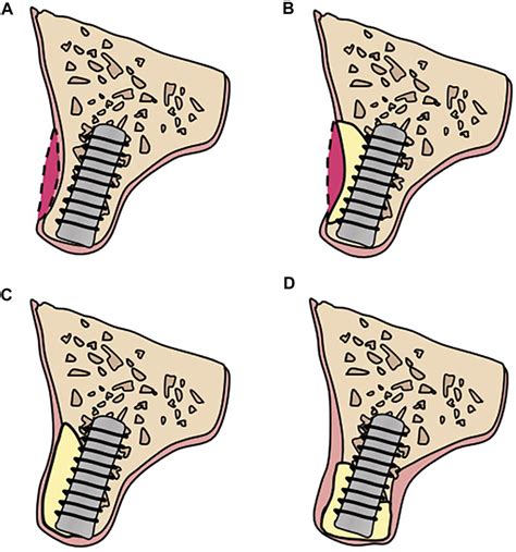 Bone Defects Classification A Class 1 Ideal Alveolar Bone Download Scientific Diagram