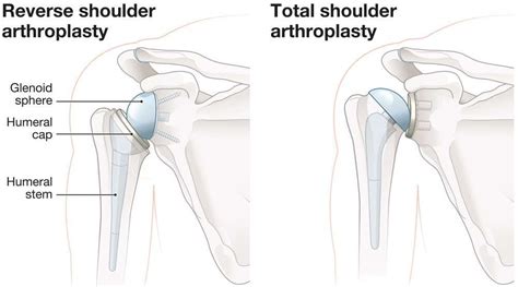 Shoulder Replacement Surgery In Thane Dr Bakul Arora