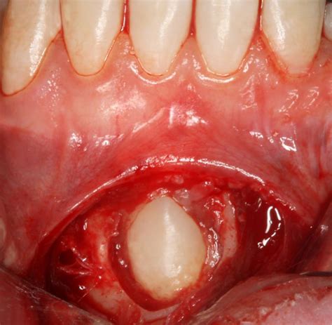 Tooth Impaction Alchetron The Free Social Encyclopedia