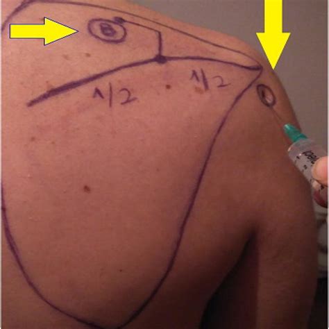 Subacromial Corticosteroid Injection A And Suprascapular Nerve Block Download Scientific