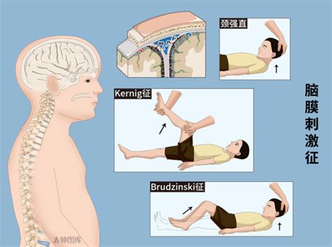 脑膜刺激征 医学插画