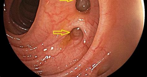 Divertículos En El Colon Qué Son Cómo Prevenirlos Sus Síntomas Y Opciones De Tratamiento