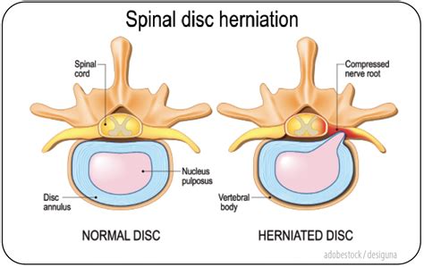 Closing The Coding Gap For Annular Defects Aapc Knowledge Center