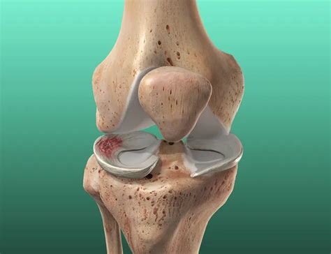 Meniscus Tear Treatment C7physio
