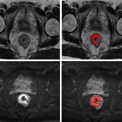 Sketchy Annotation Of Colorectal Cancer Lesions Figure 1 Is A Ct