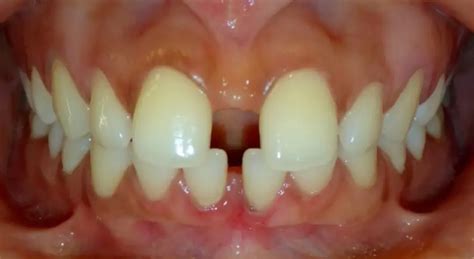 Everything You Need To Know About Spacesgaps Between Teeth