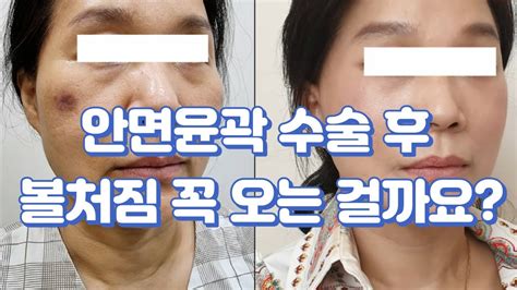 안면윤곽 수술 후 볼처짐은 꼭 오는 걸까요 Youtube