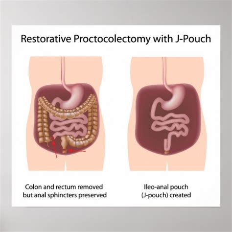 Restorative Proctocolectomy