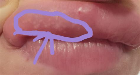 Ford Tiny Bumps On Lips