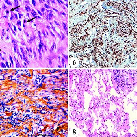 Higher Magnifi Cation In Fig 1 Showing Hyperchromatic Nuclei With Download Scientific Diagram