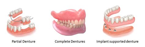 Fixed Or Removable Dentures ⭐️ Partial Or Complete Denture With Dental