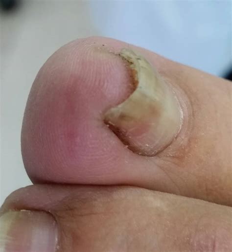 La UÑa En Pinza Es Una Dermatología Integral Pachuca