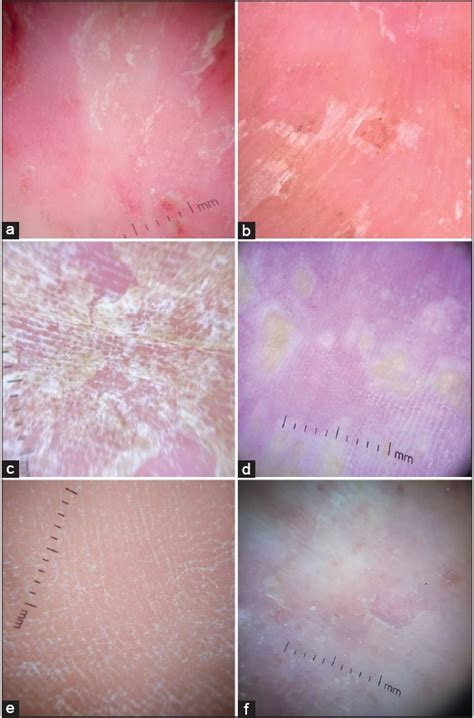 Reviewarticle Our Dermatology Online