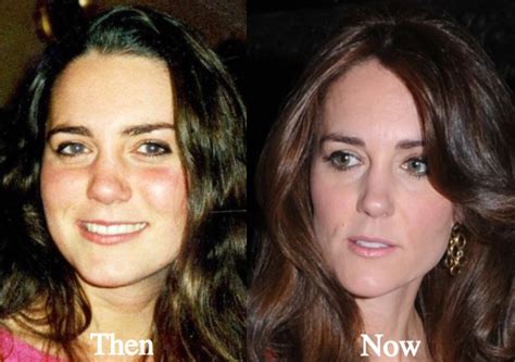 Kate Middleton Plastic Surgery Rumors Now And Then Pictures Latest