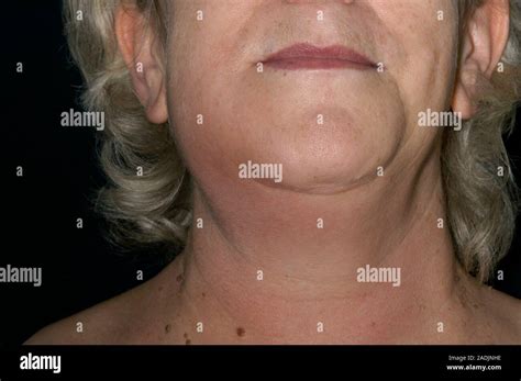 Dental Abscess Swelling At Upper Left Affecting The Right Side Of A