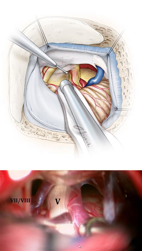 Microvascular Decompression For Trigeminal Neuralgia Cohen Collection Volumes The
