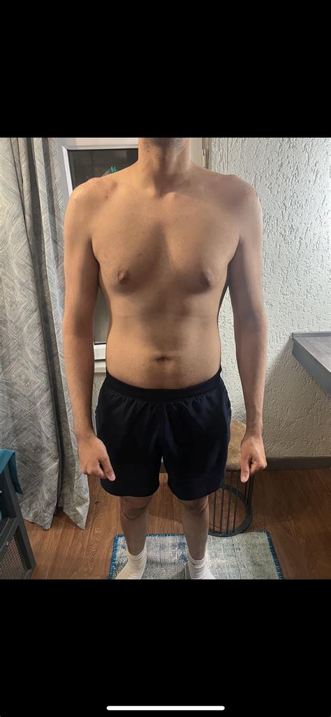 Istanbul Surgery Report R Gynecomastia
