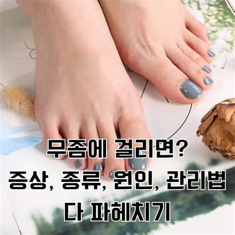 무좀 증상 종류 원인 관리법 A~z까지 건강 공방