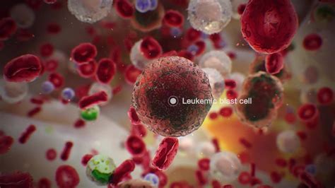 Overview Of Leukemia Blood Disorders Msd Manual Consumer Version