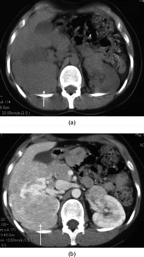 Axial Ct Demonstrates Atypical Or Minimal Fat Angiomyolipomas Download Scientific Diagram