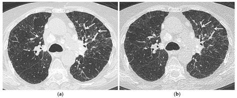 Sarcoidosis Lung Icd 10