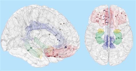 Un Dispositivo Cerebral Y Un Algoritmo Traen Esperanza Para El