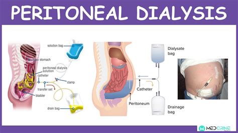 Abdominal Pain After Peritoneal Dialysis At Anne Burchette Blog