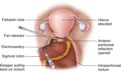 Laparoscopic Proctocolectomy Abdominal Key