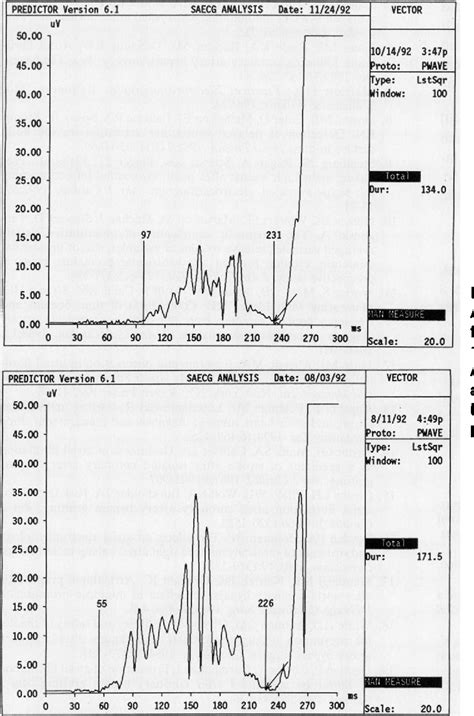 Figure 2 From Value Of The P‐wave Signal‐averaged Ecg For Predicting Atrial Fibrillation After