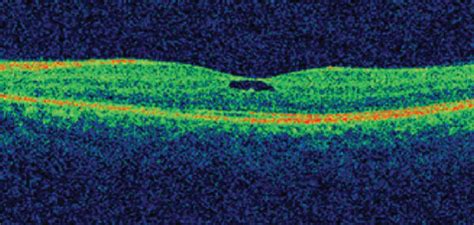 A L Serial Oct Scans Showing The Evolution Of Maculopathy Obtained