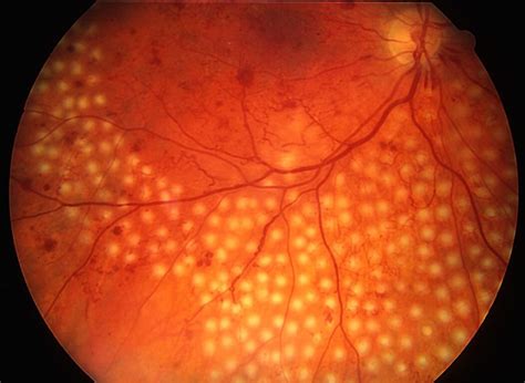 Diabetic Eye Disease Plano Tx Texas Macula And Retina