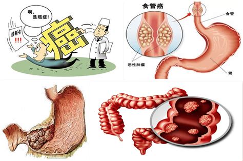 消化道肿瘤筛查，哪些人需要提高警惕？ 消化道疾病科普园地（1）检查