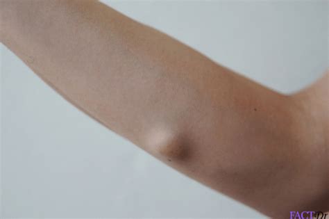 Sebaceous Cyst Armpit