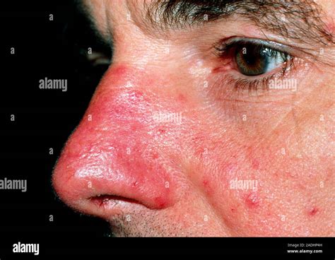 Rosacea Red Skin Rash And Pustules Across A Mans Nose This Is Due To A Chronic Skin Disease