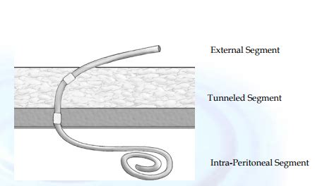 Tenckhoff Catheter Insertion By A Nephrologist Renal Fellow Network