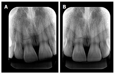 Horizontally Root Fractured Teeth With Pulpal Vitality Two Case