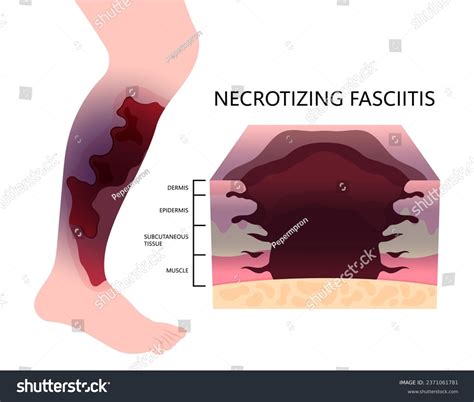 Necrotizing Fasciitis Diagram Necrotizing Fasciitis Pathogenesis And
