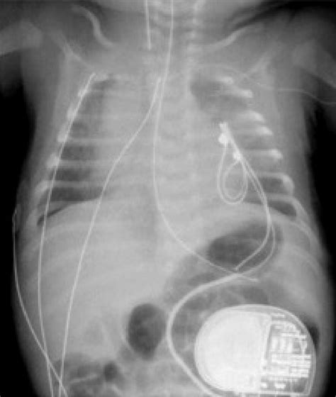 Chest Radiograph Symmetrical Diffuse Interstitial Infiltrates