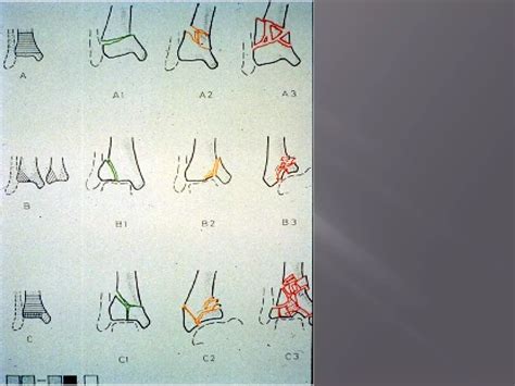 Lecture Ucmc Pilon Plafond Fracture Distal Tibia Ppt Death Injury